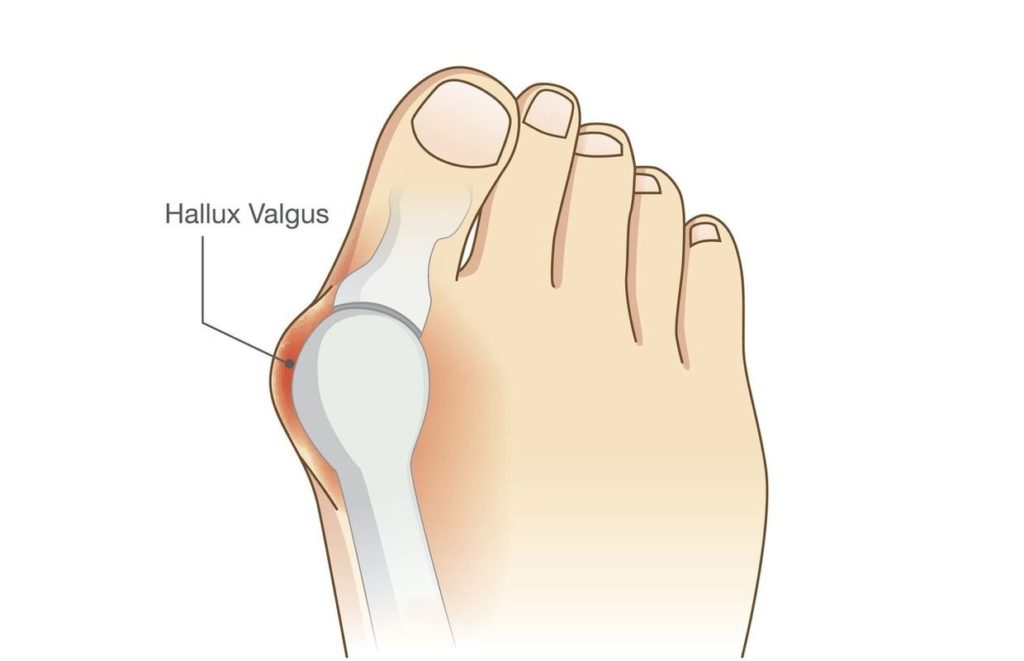 Hallux Valgus : Symptomes, Causes Et Traitement – WATQVT
